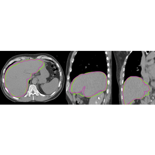 SurePlan™ LiverY90 – Gamma Gurus